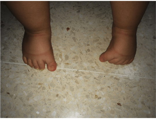 Mi hijo camina con los pies hacia dentro | Traumatólogo infantil y ...