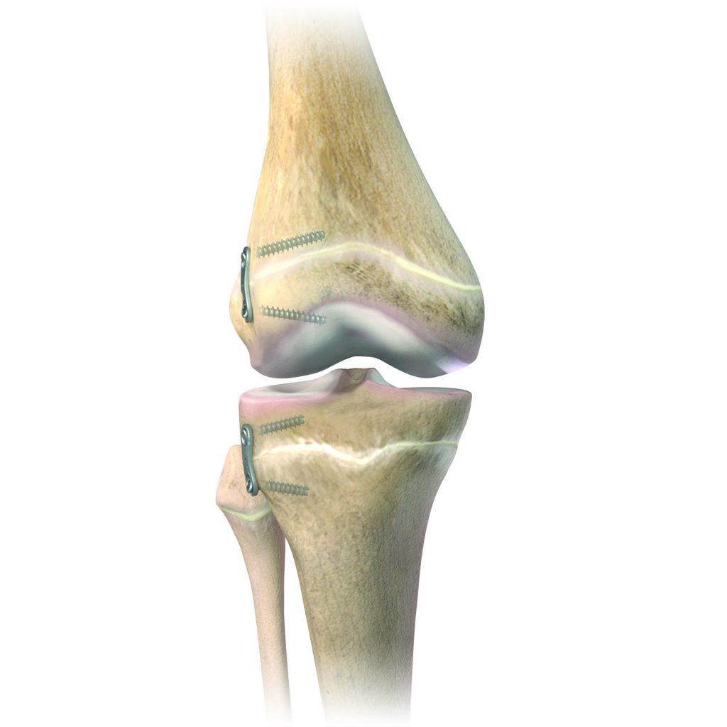¿Rodillas en X en el niño (genu valgo)? ¿Rodillas en O (genu varo ...