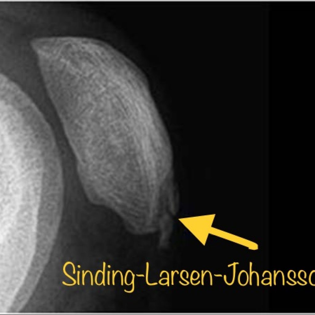 Enfermedad de Osgood-Schlatter, Sinding-Larsen-Johansson y Sever. La ...