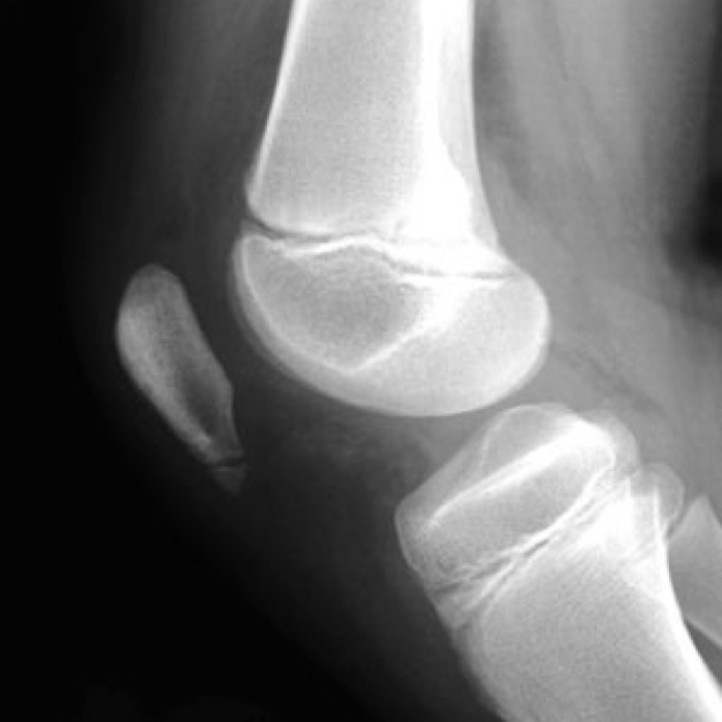 Enfermedad de Osgood-Schlatter, Sinding-Larsen-Johansson y Sever. La ...